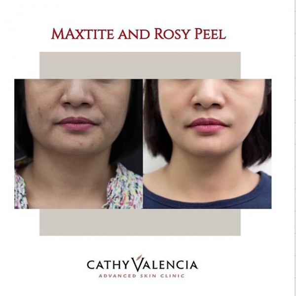 CV SIGNATURE PEELS – Cathy Valencia