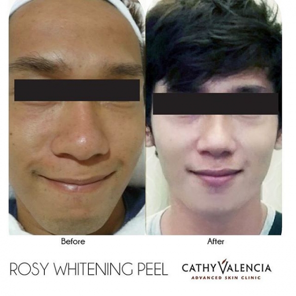 CV SIGNATURE PEELS – Cathy Valencia